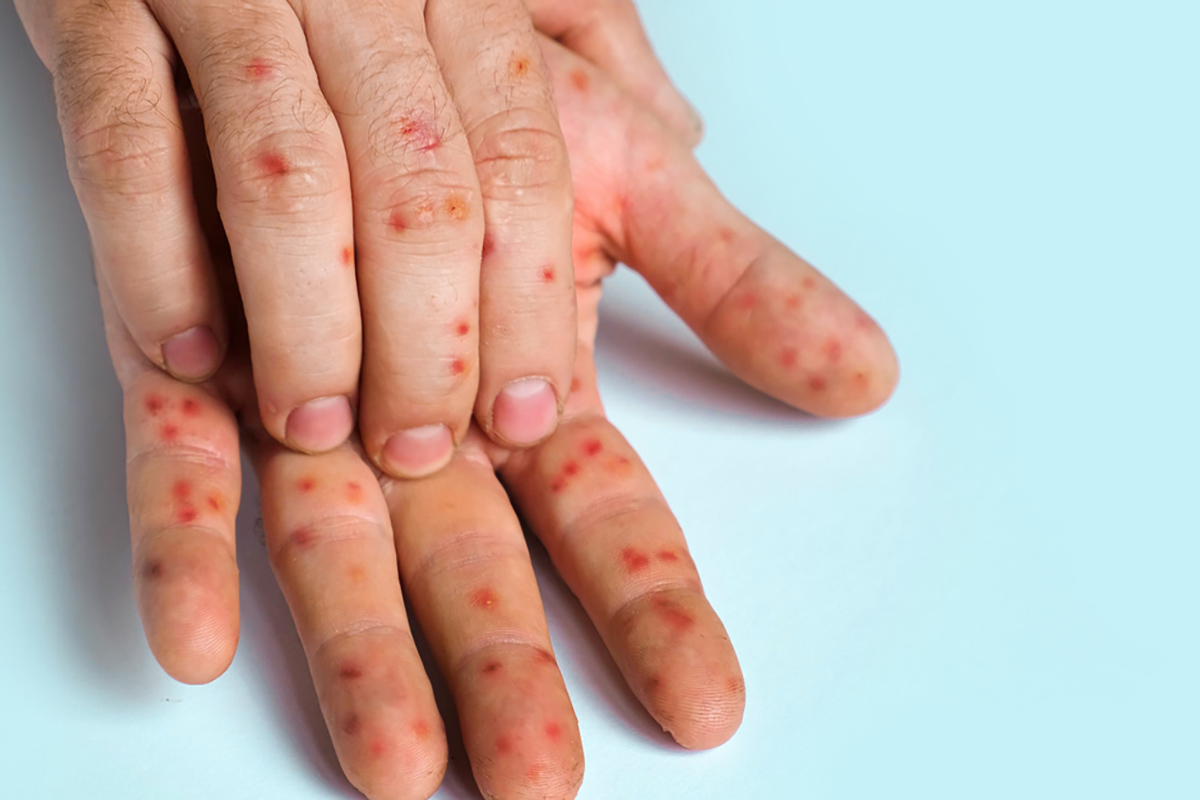 Measles - What to look out for and what you need to know - Hazelhill ...